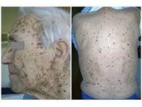 Seborrheic keratosis treatment in dubai